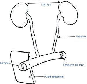 Revisión de la exenteración pélvica en el cáncer de cérvix. Descripción ...