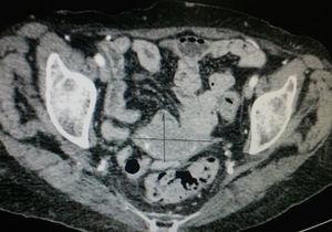 Presentación atípica de la piómetra en la mujer anciana | Clínica e ...