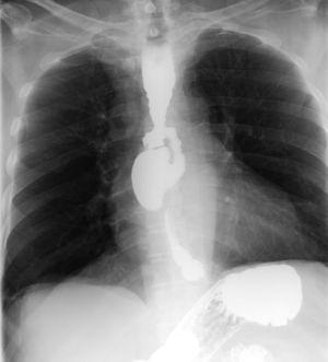 Divertículos esofágicos: una causa infrecuente de agudización en la ...