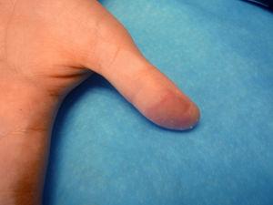 Pulpitis palmar como única expresión de infección por SARS-CoV-2 ...