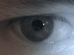 Corectopia como manifestación neurooftálmica en un caso de ...