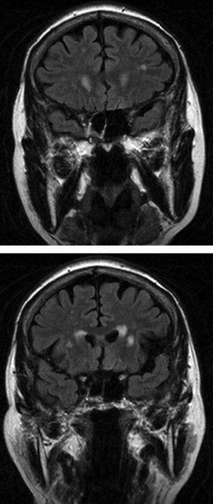 Pacientes con enfermedad de Parkinson avanzada con y sin congelación de ...