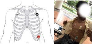 PQRST wave detection on ECG signals | Gaceta Sanitaria