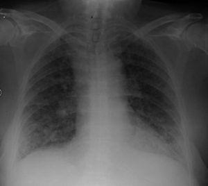 Linfangitis carcinomatosa pulmonar. Una excepcional forma de ...