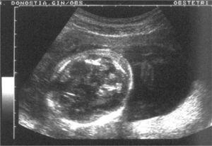 Variante del síndrome de Dandy Walker. Diagnóstico y consejo prenatal ...