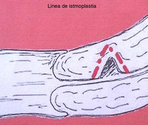 Cirugía histeroscópica del istmocele: ¿solución a un viejo problema ...