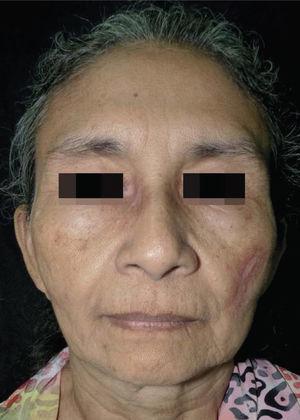 Atypical presentation of cutaneous herpes simplex virus in a patient ...