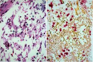Primary cutaneous cryptococcosis: the importance of early diagnosis ...