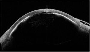 Glaucoma maligno tras implante XEN45 | Archivos de la Sociedad Española ...