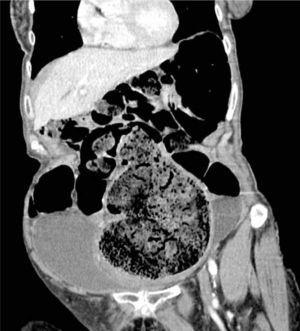 Caso clínico radiológico fecaloma : importante complicación en adultos ...