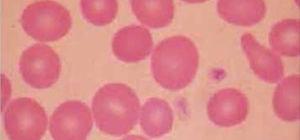 INTERPRETACIÓN CLÍNICA DEL HEMOGRAMA | Revista Médica Clínica Las Condes