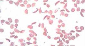 INTERPRETACIÓN CLÍNICA DEL HEMOGRAMA | Revista Médica Clínica Las Condes