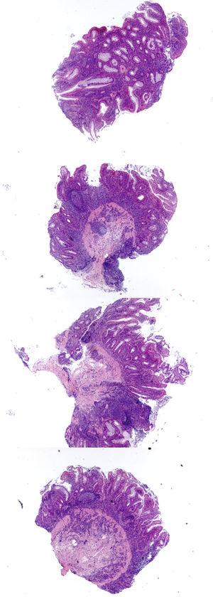 Histología en la Enfermedad Inflamatoria Intestinal | Revista Médica ...