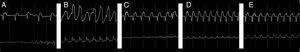 Arterial waveform during extracorporeal cardiopulmonary resuscitation ...
