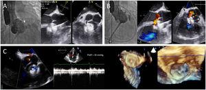 Ruptured sinus of Valsalva aneurysm: A reversible cause of ...