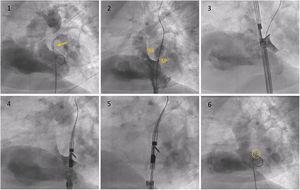 A new era in patent foramen ovale closure – a percutaneous suture-based ...