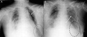«Surco costofrénico profundo» en paciente con trasplante cardiaco ...