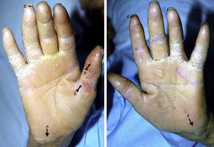 Lesiones descamativas en palmas y plantas: caso clínico | Medicina ...