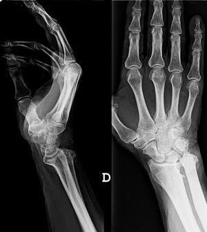 Síndrome de Vaughan-Jackson, a propósito de un caso | Medicina de ...