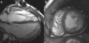 Left ventricle non-compaction cardiomyopathy: Different clinical ...