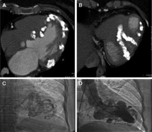 Heart calcification (idiopathic cardiac osseous metaplasia): A case ...