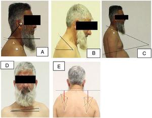 Postural abnormalities in phenotypes of chronic obstructive pulmonary ...