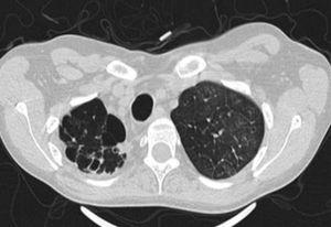 Multidrug resistant tuberculosis versus non-tuberculous mycobacterial ...