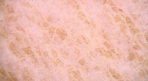 Dermatosis Neglecta or Terra Firma-Forme Dermatosis | Actas Dermo ...