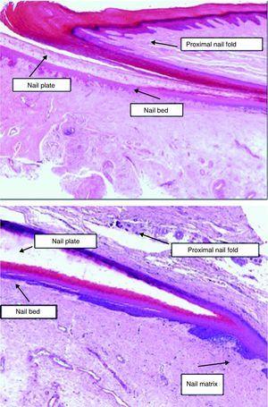 Nail Histopathology | Actas Dermo-Sifiliográficas