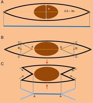 Double M-plasty for Excisional Biopsy of Suspected Melanoma | Actas ...
