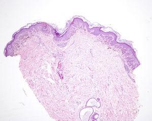Reticulate Hyperpigmentation of the Flexures | Actas Dermo-Sifiliográficas