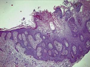 Nodular Peristomal Lesions | Actas Dermo-Sifiliográficas (English Edition)