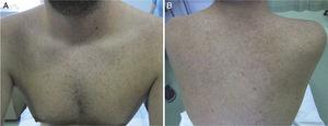 Zika Virus: Cutaneous Manifestations in 3 Patients | Actas Dermo ...