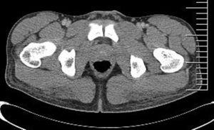 Recurrent Buttock Cellulitis in a Young Man | Actas Dermo ...