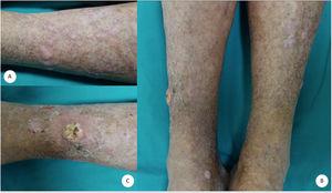 Hypertrophic Lichen Planus: Importance of Follow-Up and ...