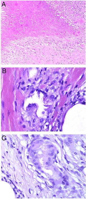 Granulomas in Dermatopathology: Principal Diagnoses - Part 1 | Actas ...