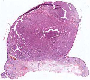 Primitive Polypoid Granular Cell Tumor | Actas Dermo-Sifiliográficas