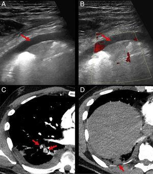 Diagnosis of Pulmonary Infarction by Thoracic Ultrasonography ...