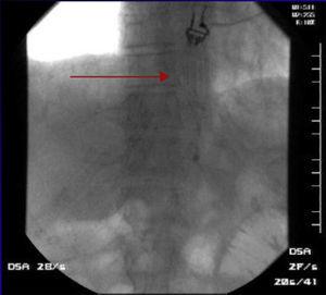 Duplicação da veia cava inferior com drenagem pela veia ázigos. A ...