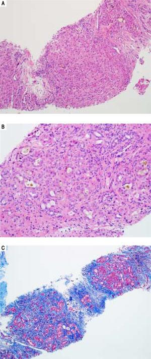 Cryptogenic Cirrhosis and Sitosterolemia: A Treatable Disease If ...