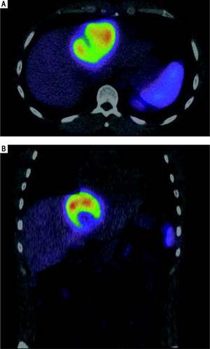 Two Cases of Primary Hepatic Neuroendocrine Tumors and a Review of the ...