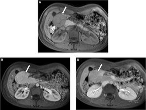 Pedunculated hepatic focal nodular hyperplasia | Annals of Hepatology