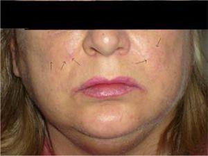 Skin manifestations of liver diseases | Annals of Hepatology