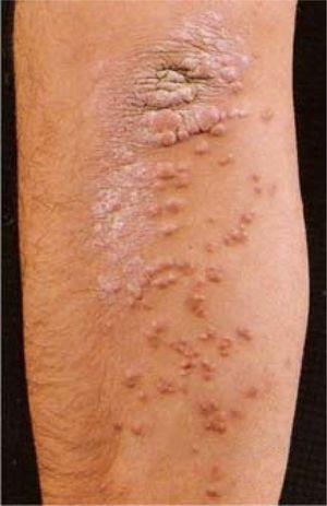 Skin manifestations of liver diseases | Annals of Hepatology