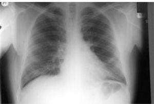 Lymphocytic interstitial pneumonitis (LIP)-The liver and the lung ...