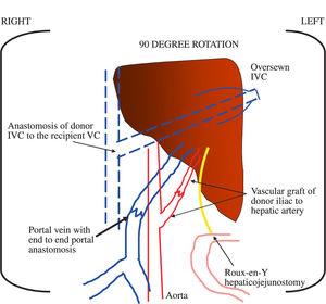 Orthotopic liver transplantation in an adult with situs inversus: an ...