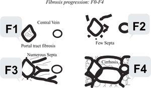 Risk factors for liver fibrosis progression in patients with chronic ...