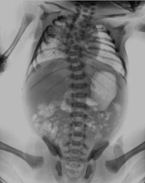 Spondylothoracic dysostosis, Jarcho Levin syndrome. Case report ...
