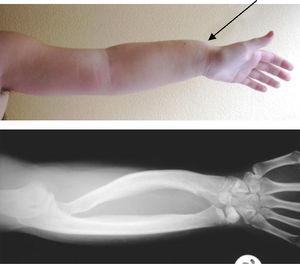 Discondrosteosis de Leri-Weill. Mutación en gen SHOX y expresividad ...