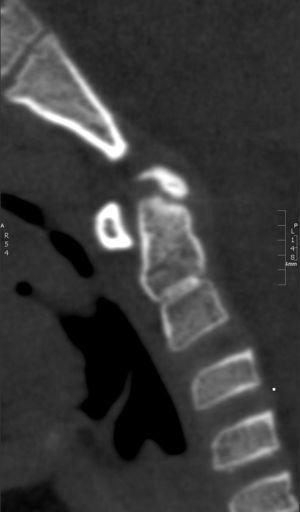Ossiculum terminale de Bergman. Una entidad poco conocida | Anales de ...